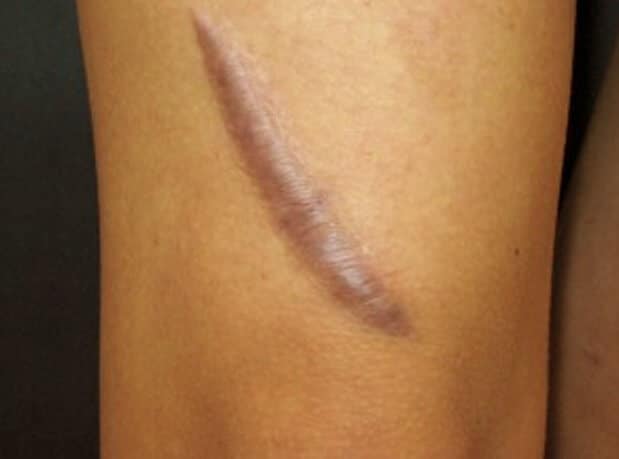 Hai un Cheloide ad una cicatrice?La ferita è spessa e adesa?