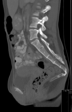 Coccigodinia: La Soluzione per il Dolore al Coccige
