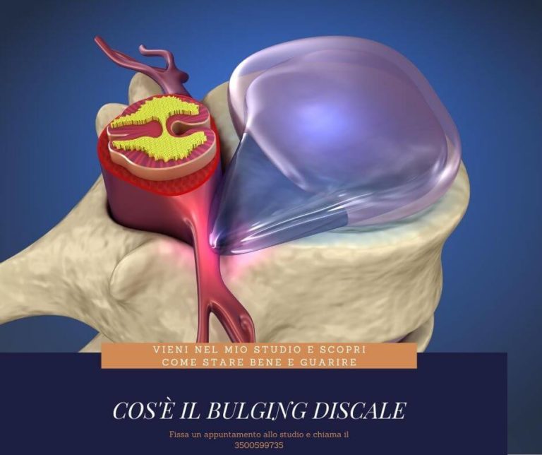Bulging discale - LA GUIDA DEFINITIVA PER STARE BENE